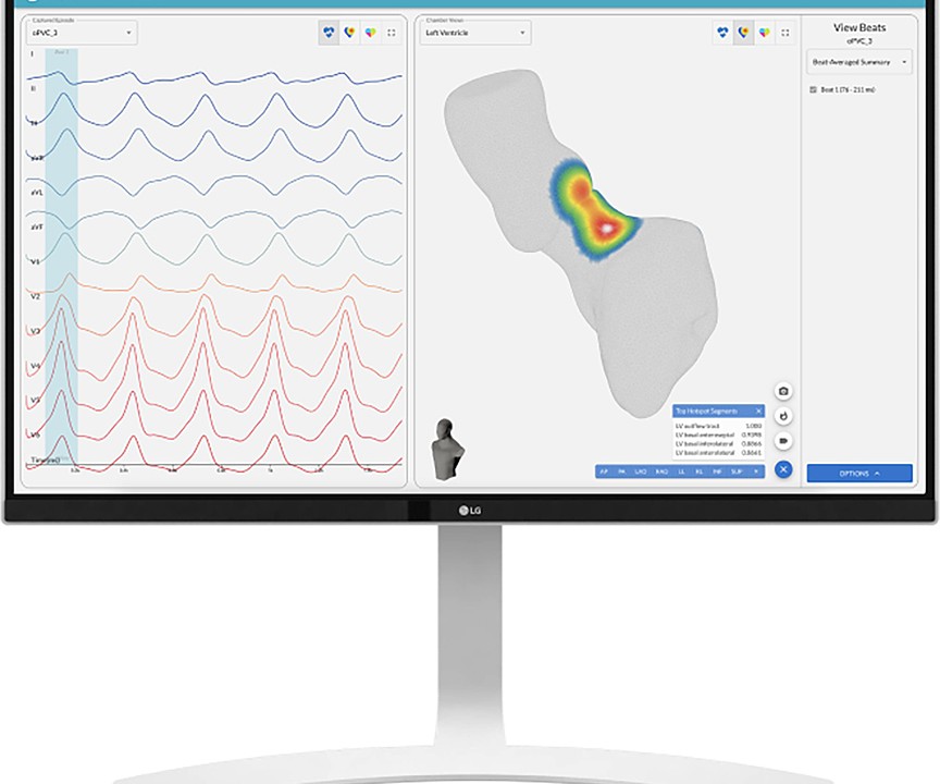 New AFib detection device being tested in Jacksonville | Jax Daily Record